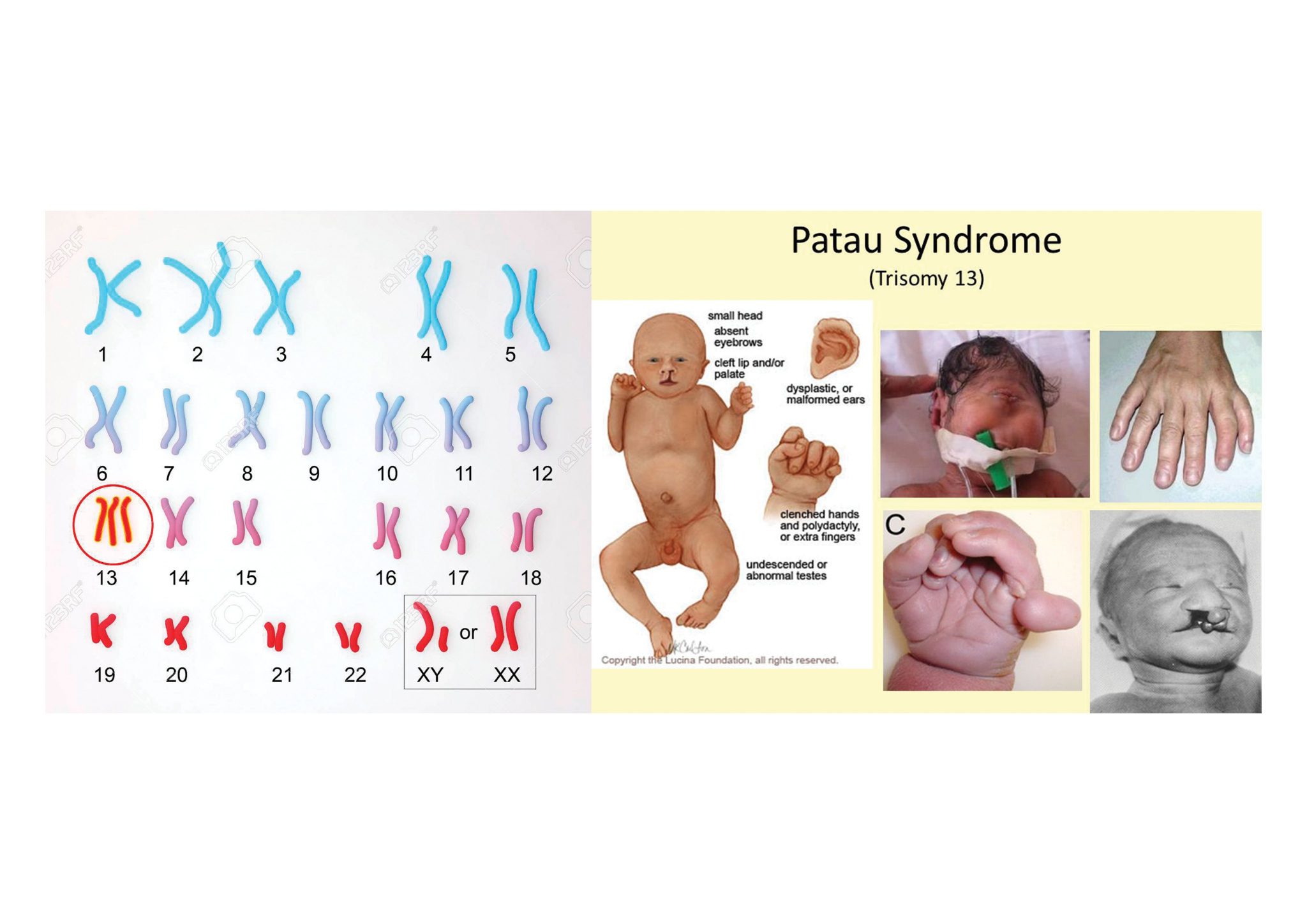 HỘI CHỨNG PATAU - GENLAB